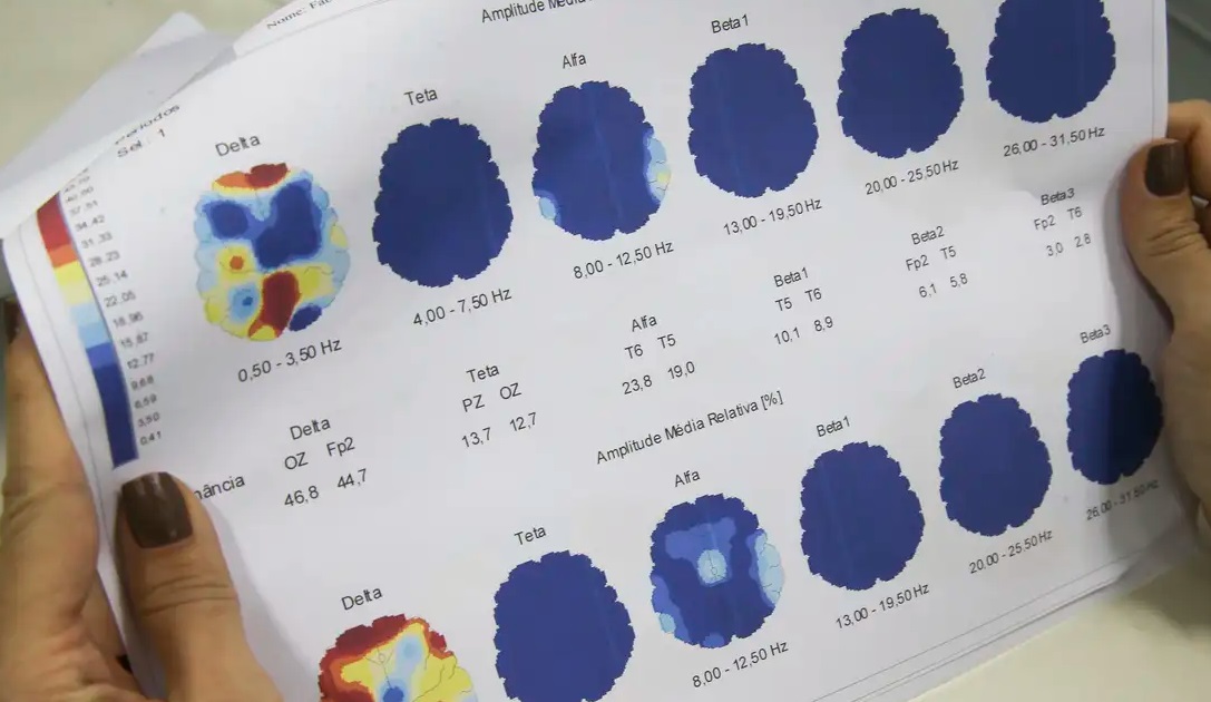 Março Roxo quer conscientizar população sobre a epilepsia